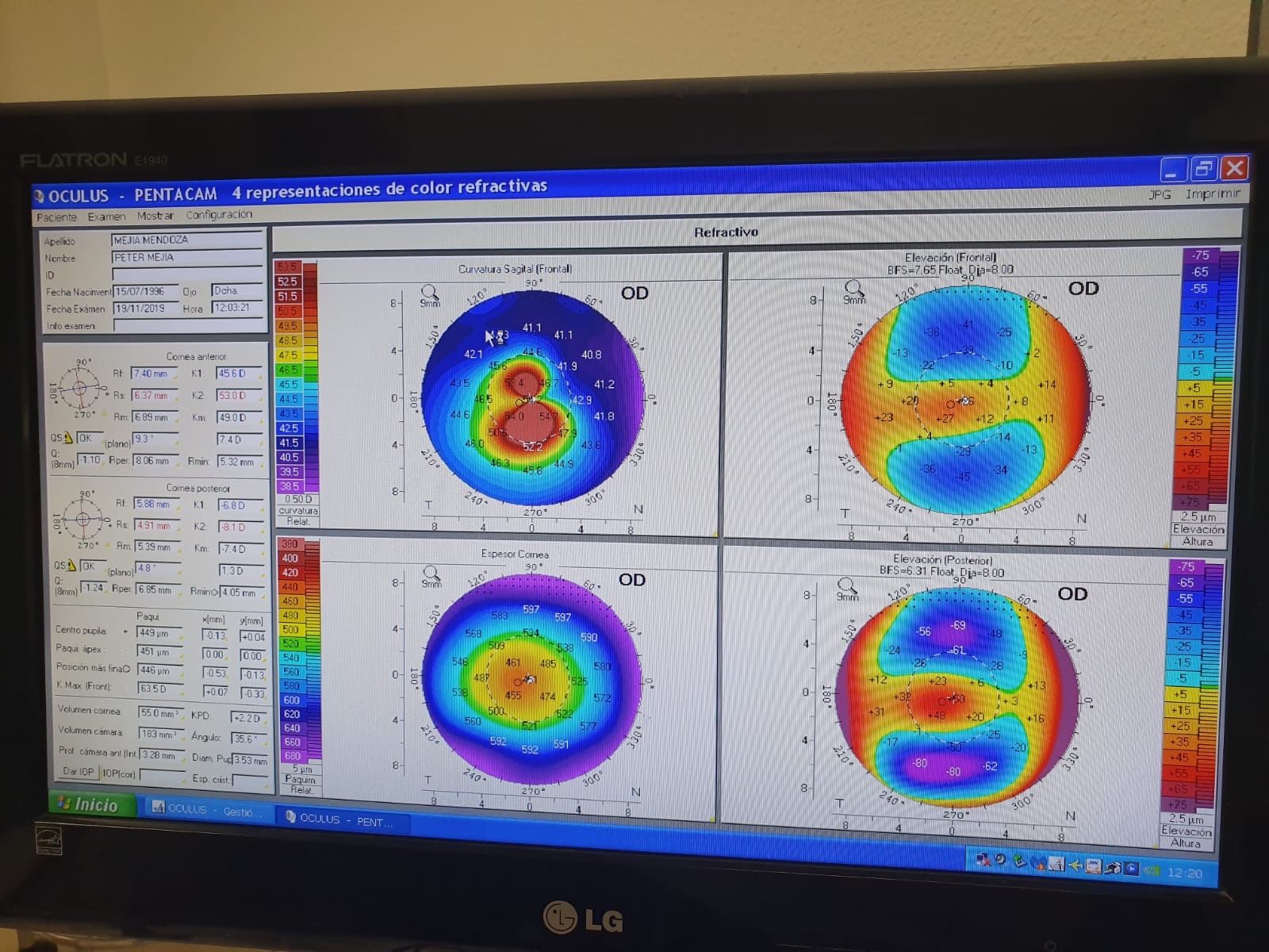 Queratocono / Cornea irregular - Visual Clinic